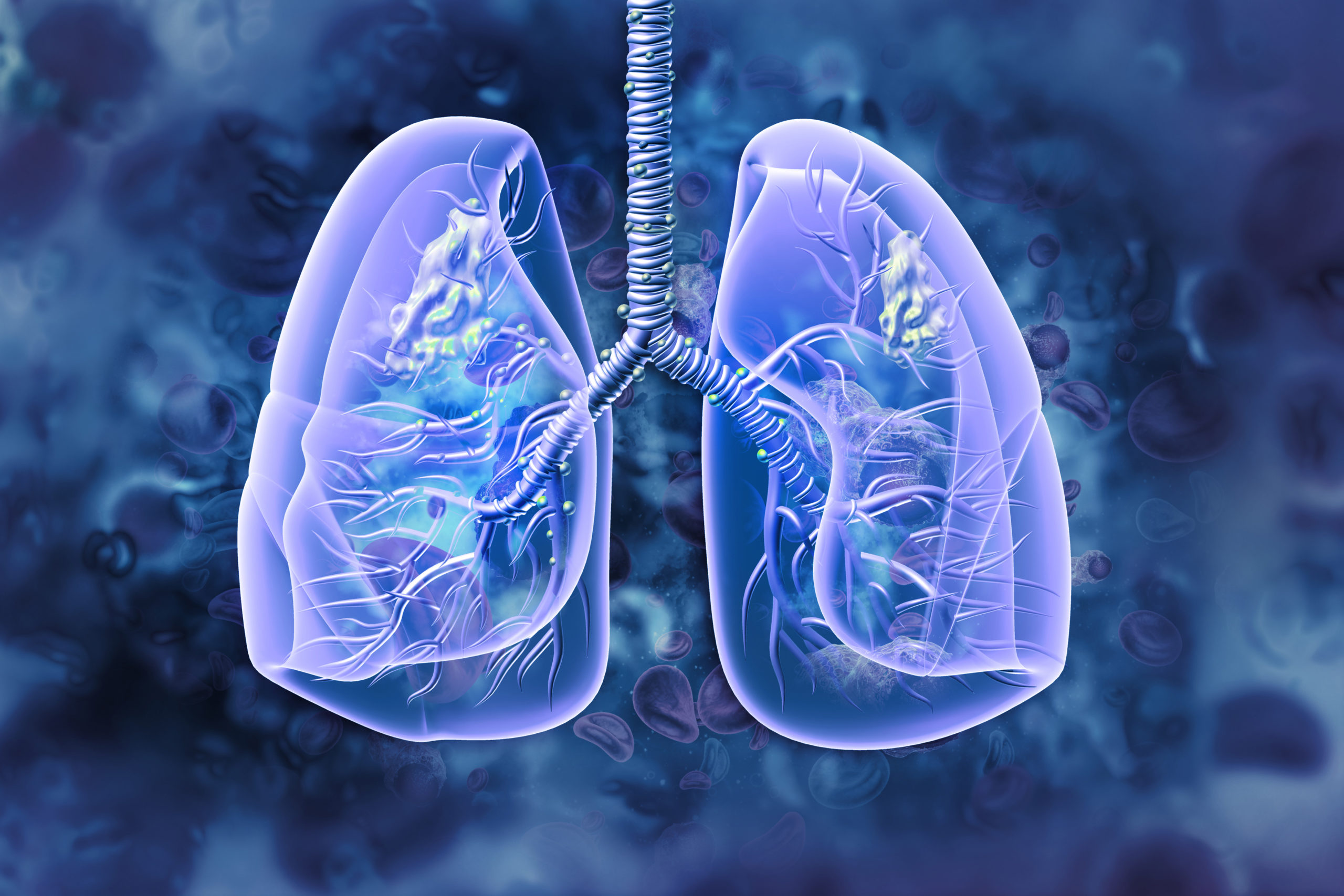 La ANMAT aprobó un nuevo tratamiento para pacientes con cáncer de ...